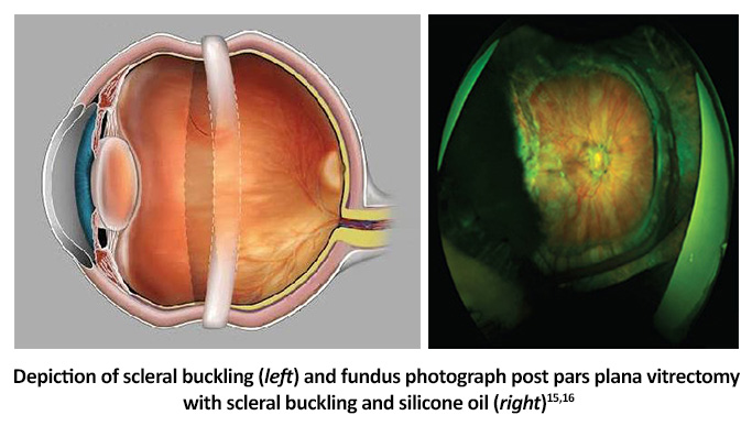 Current and Emerging Treatment – ROP | Clinician