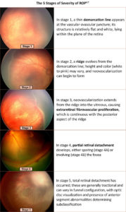 Diagnosis and Associated Risk Factors – ROP | Clinician